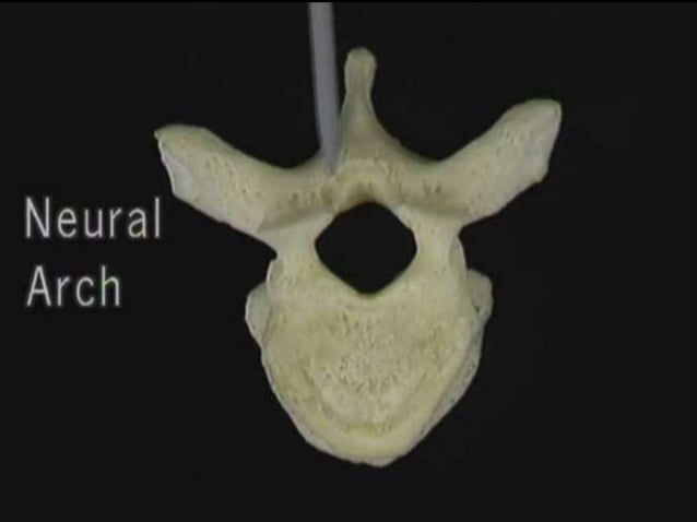 Prolpased inter vertebral disc (pivd) | PPTX | Death, Injury, or ...