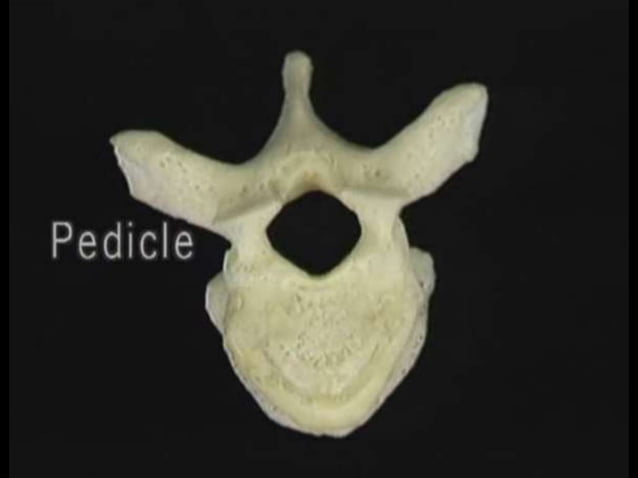 Prolpased inter vertebral disc (pivd) | PPTX | Death, Injury, or ...