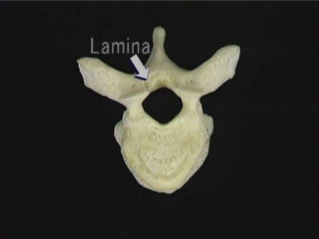 Prolpased inter vertebral disc (pivd) | PPTX | Death, Injury, or ...