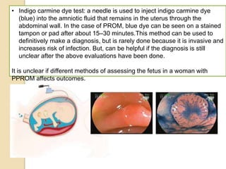 Pre-Labor Rupture of Membranes (PROM) | PPTX