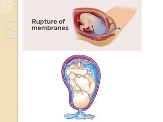 Pre-Labor Rupture of Membranes (PROM) | PPTX