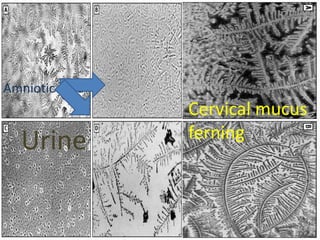 Premature rupture of membranes (PROM) | PPTX
