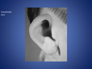 Prominent ears otoplasty | PPTX