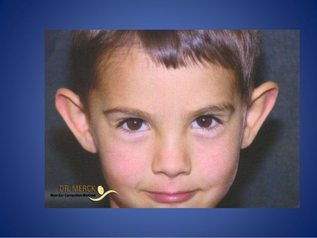 Prominent ears otoplasty