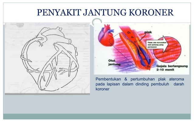 Promosi Kesehatan Penyakit Jantung Koroner (PJK).pptx