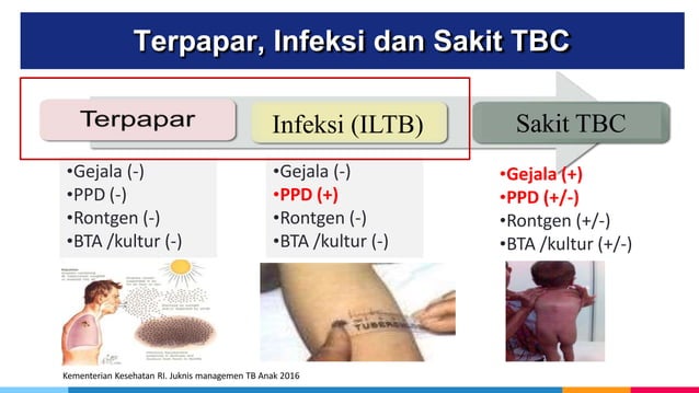 promkes rsud tbc anak.pdf