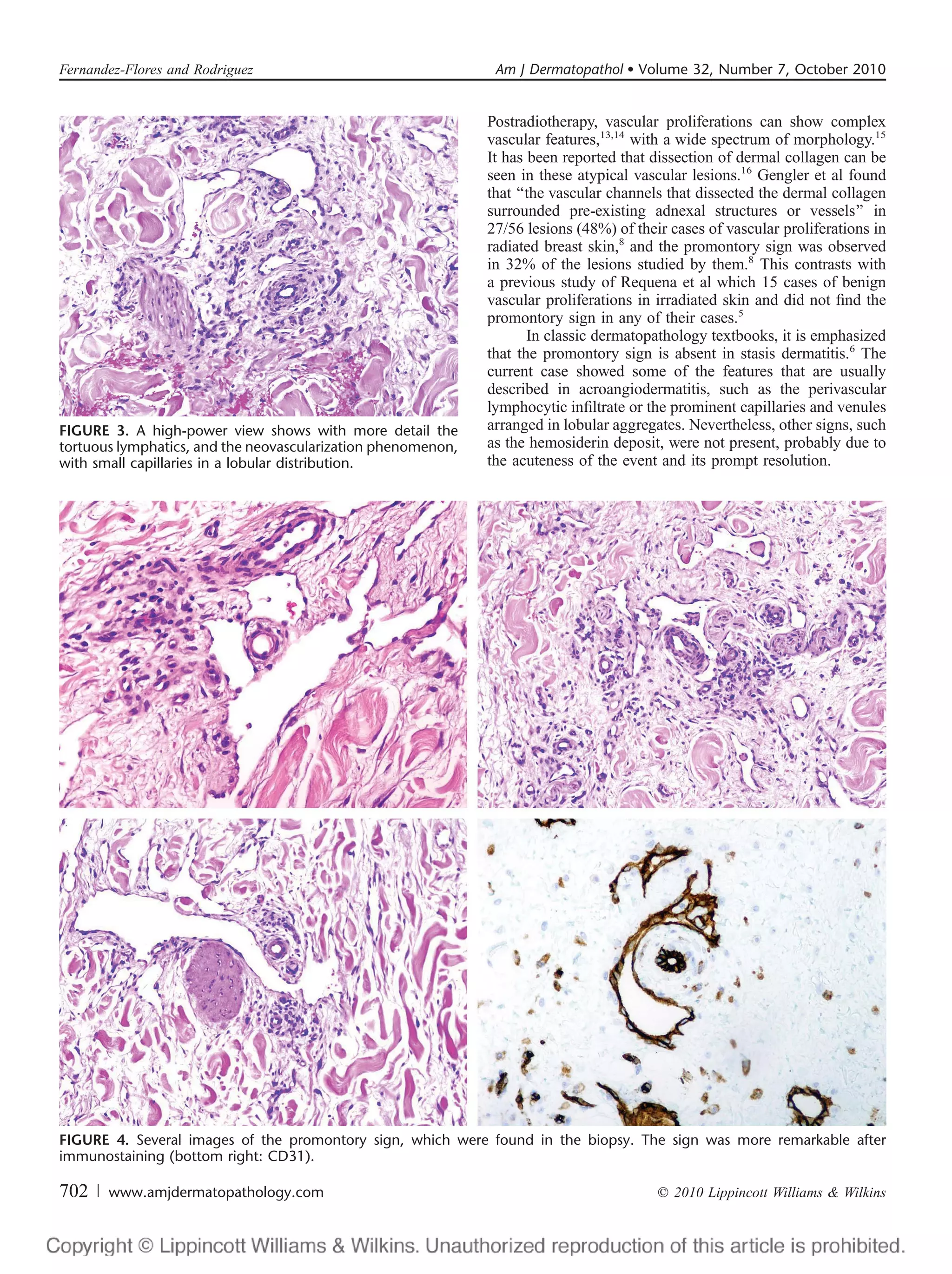 Promontory sign in a reactive benign vascular lesions | PPTX