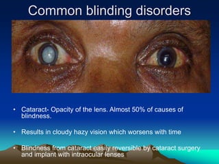 Promoting eye health for Elderly 1.ppt