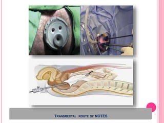 Natural Orifice Transluminal Endoscopic Surgery"NOTES" | PPTX