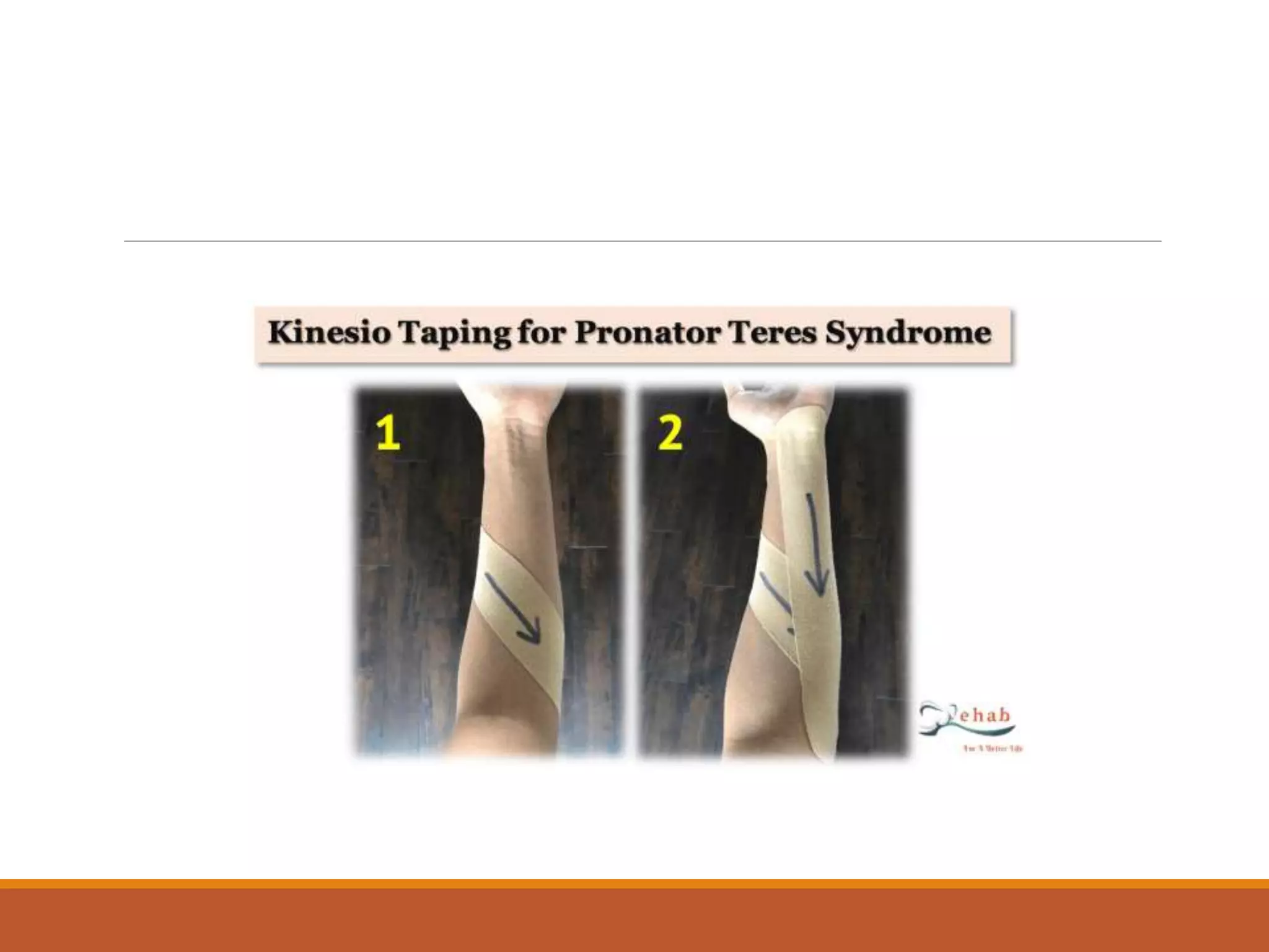 PRONATER TERES SYNDROM - Copy (2).pptx