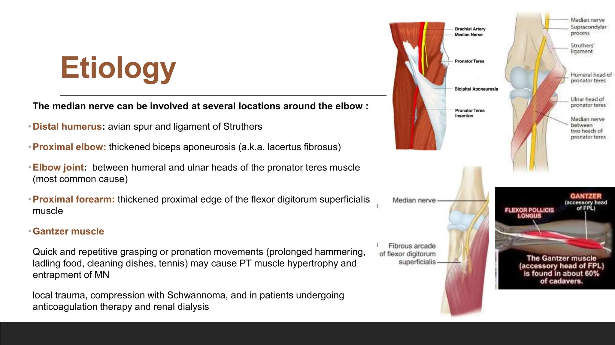 Pronator Teres Syndrome (Pronator Syndrome).pptx