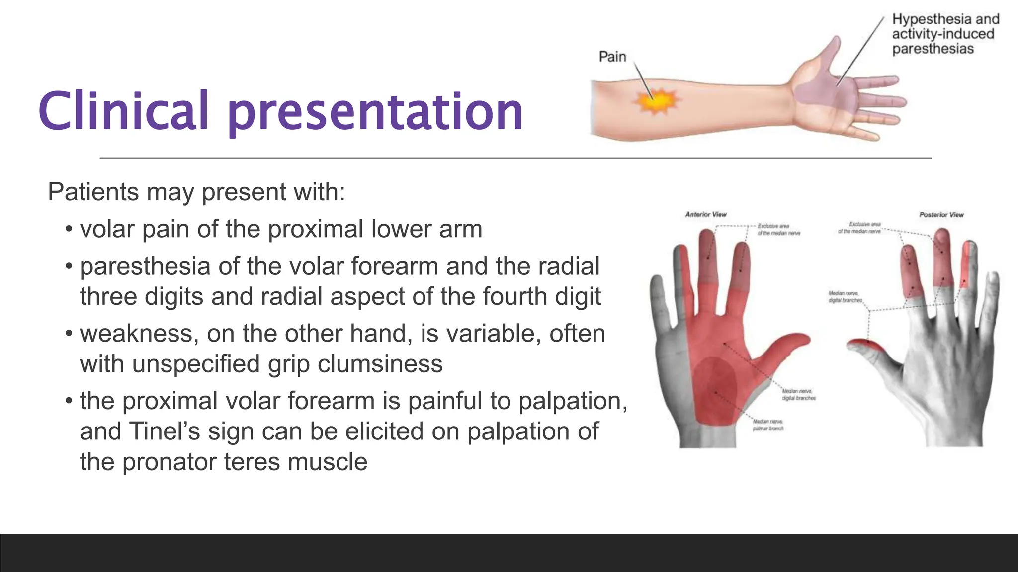 Pronator Teres Syndrome (Pronator Syndrome).pptx
