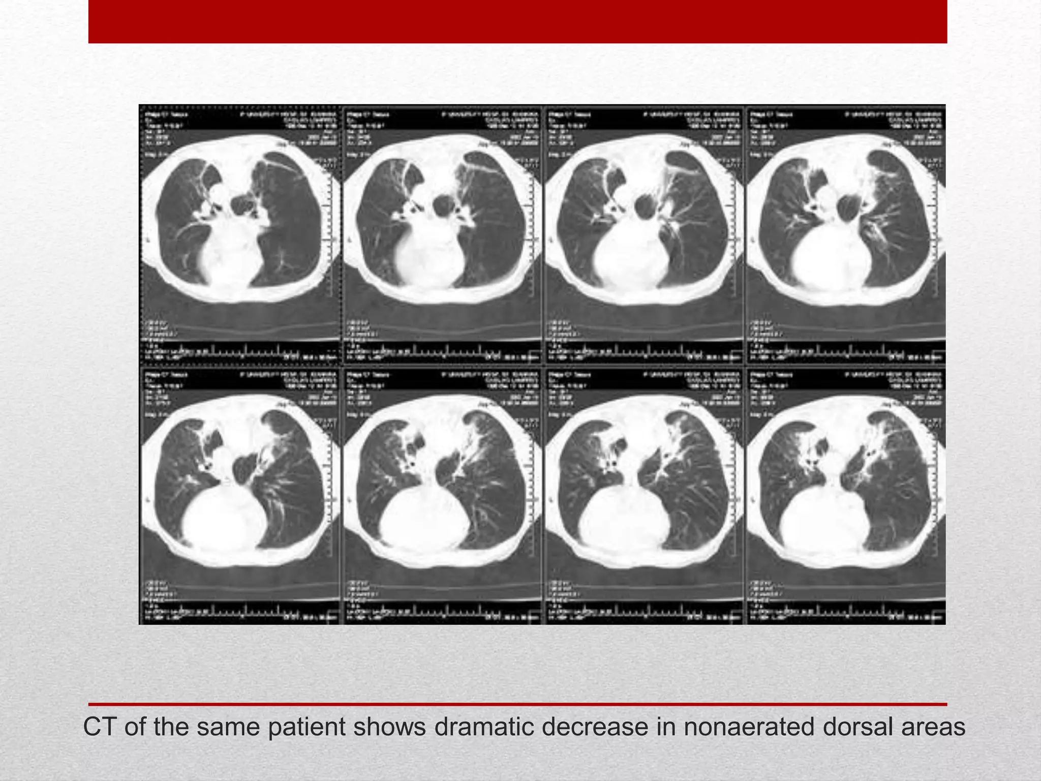 Prone position | PPTX