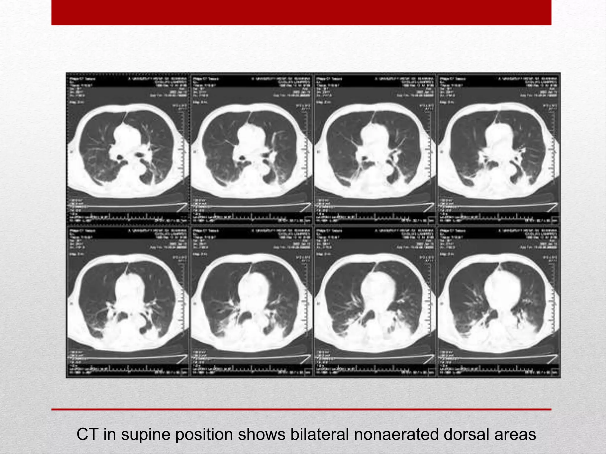 Prone position | PPTX