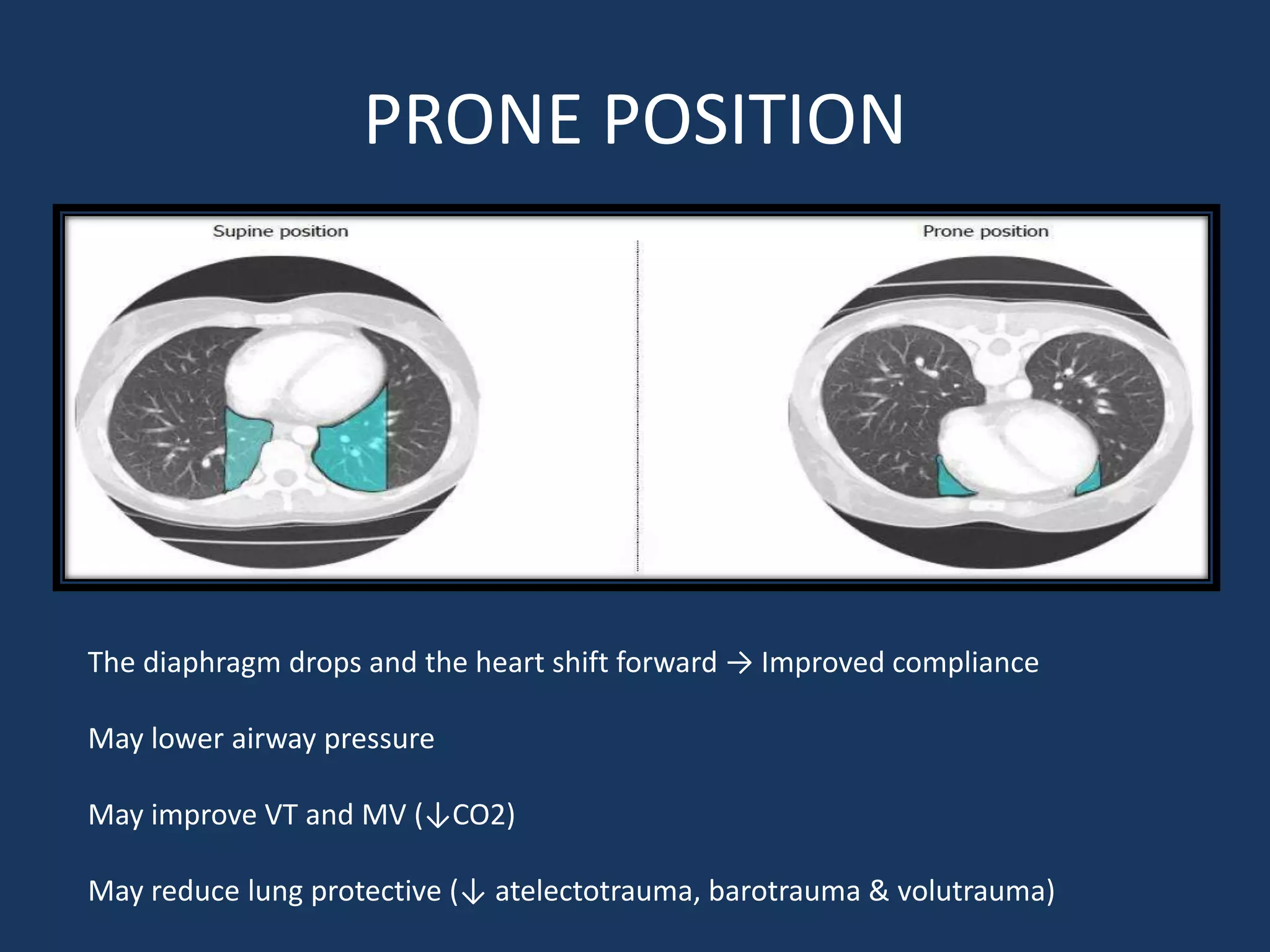 Prone Position | PPTX