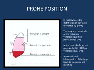 Prone Position | PPTX