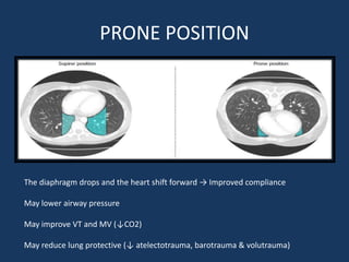Prone Position | PPTX