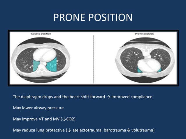 Prone Position | PPTX | Lung and Respiratory Health | Diseases and ...