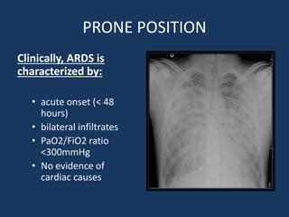 Prone Position Ards