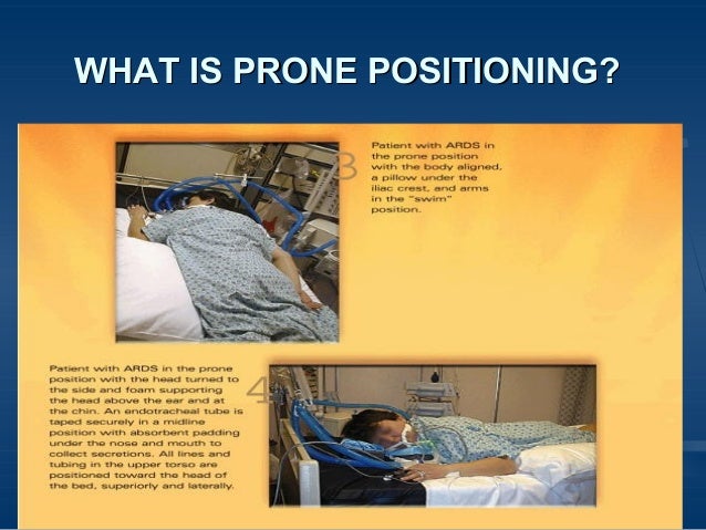 Prone Positioning in ARDS By Dr Muhammad Akram Khan Qaim KHani