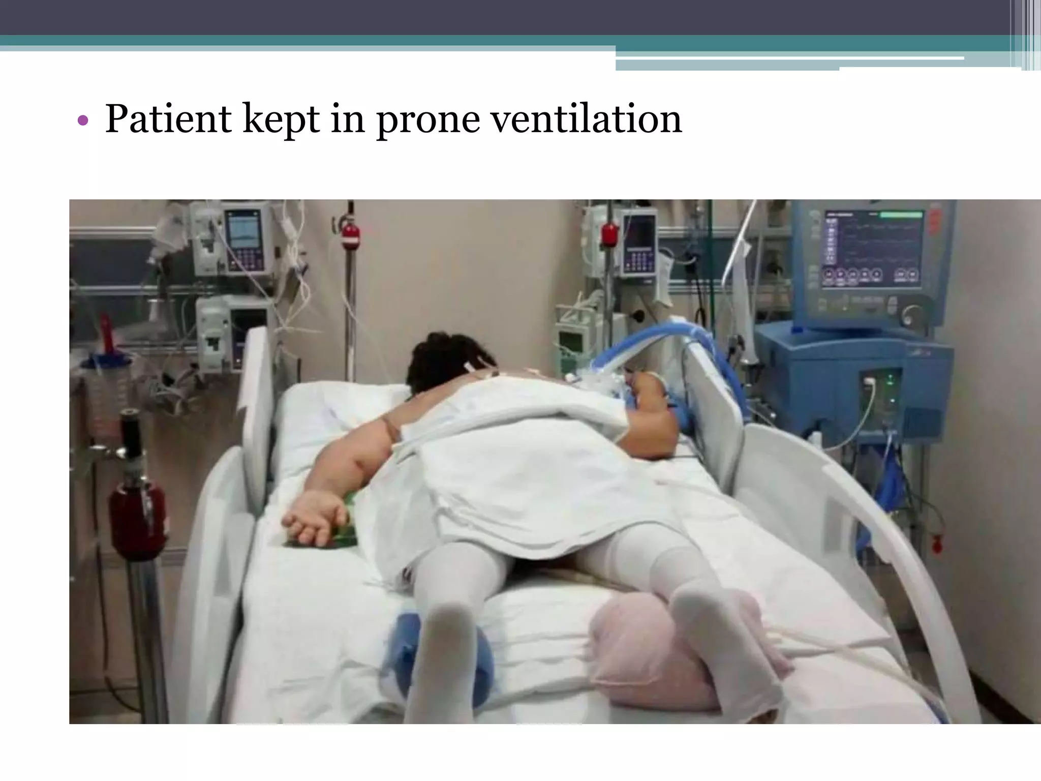 Prone ventilation | PPTX