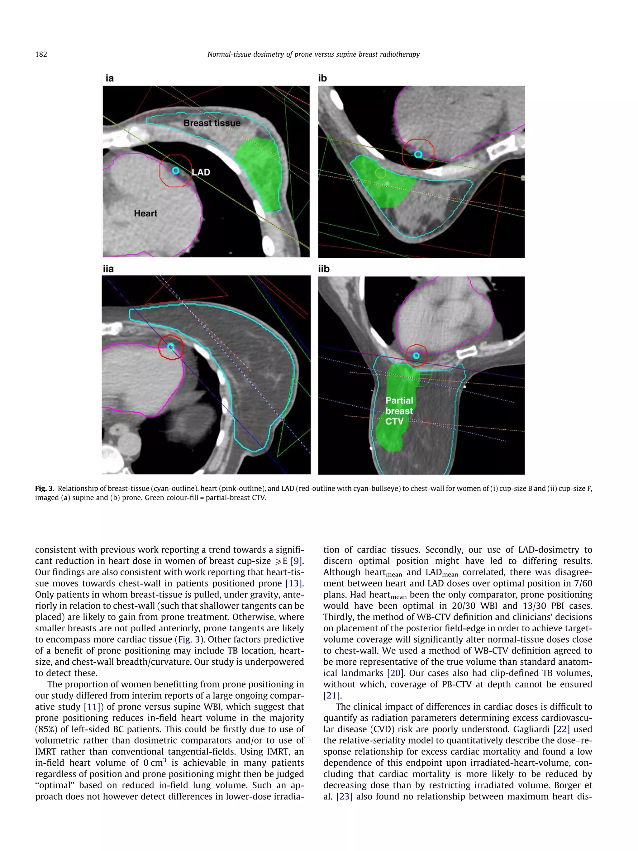 Prone versus supine positioning for whole and partial breast ...