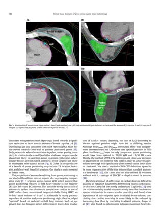 Prone versus supine positioning for whole and partial breast ...