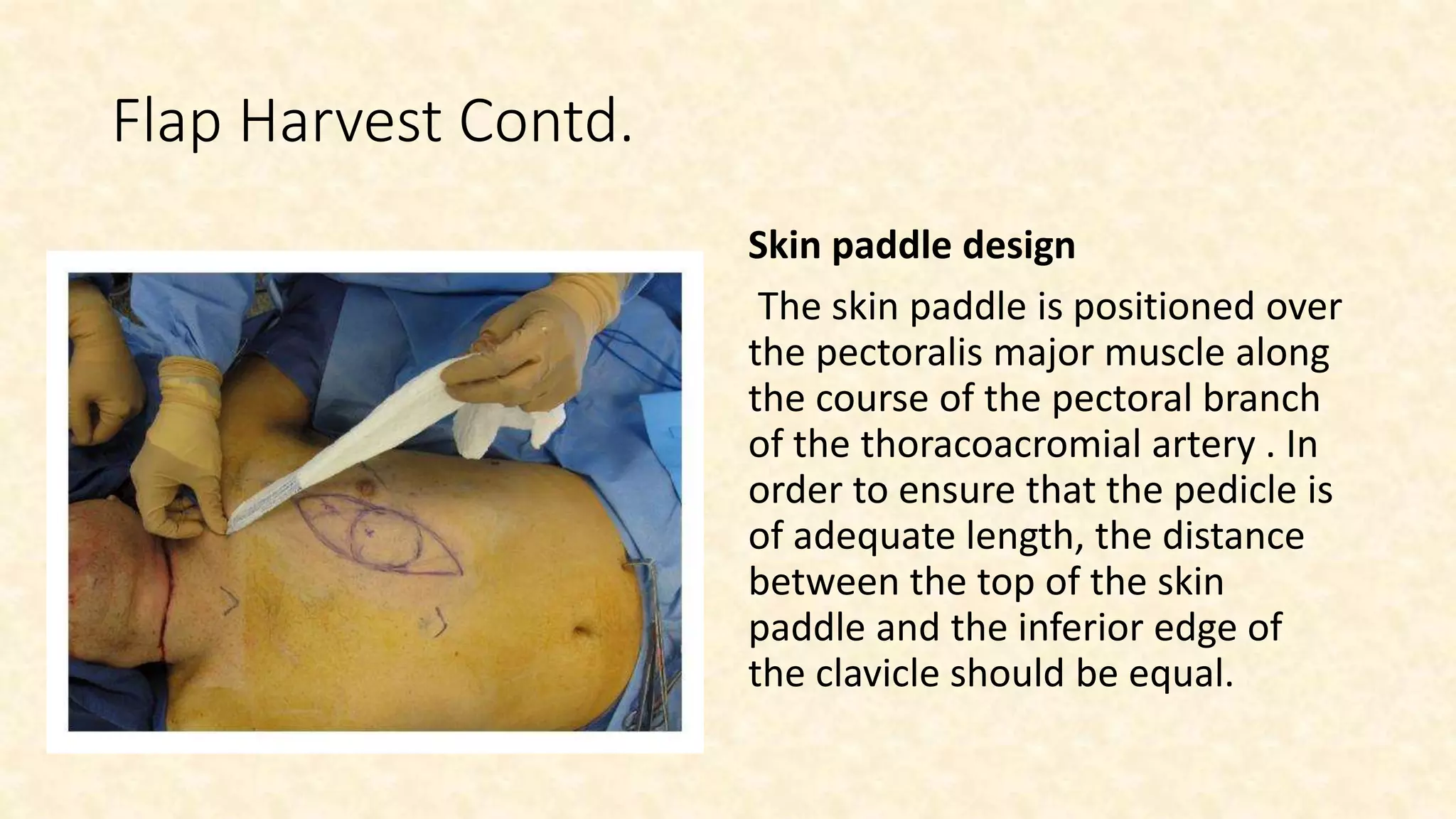 Case Presentation On Reconstruction With Pectoralis Major Myocutanious ...