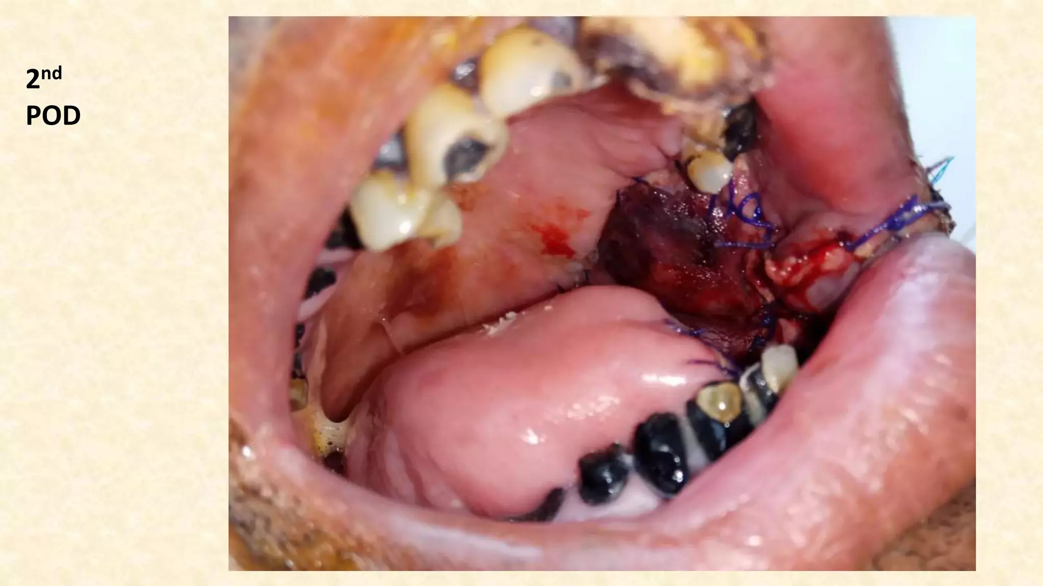 Case Presentation On Reconstruction With Pectoralis Major Myocutanious ...