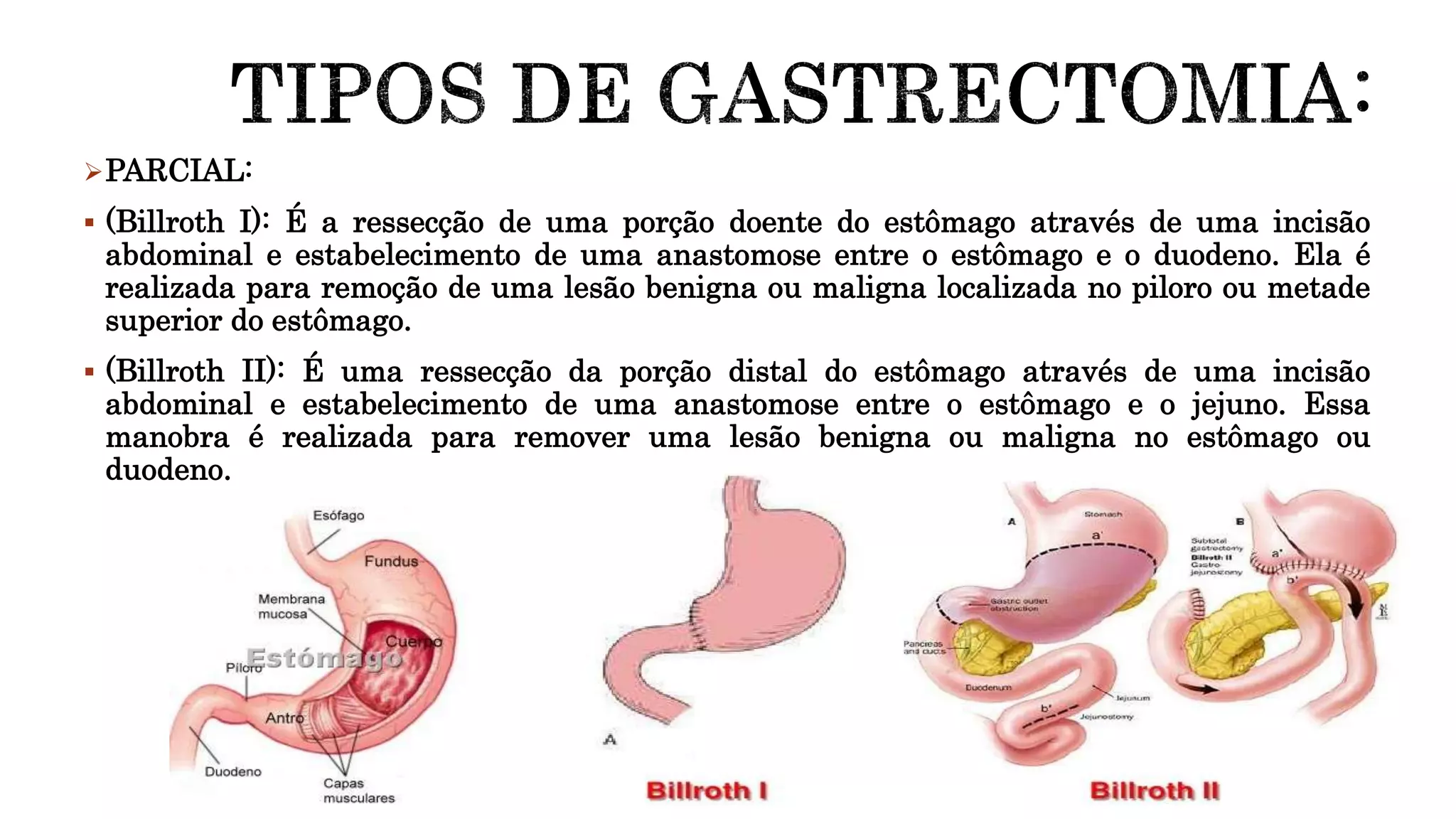 SAE Cirúrgica - Gastrotomia, Gastrostomia e Gastrectomia