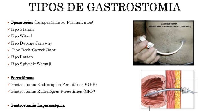 SAE Cirúrgica - Gastrotomia, Gastrostomia e Gastrectomia