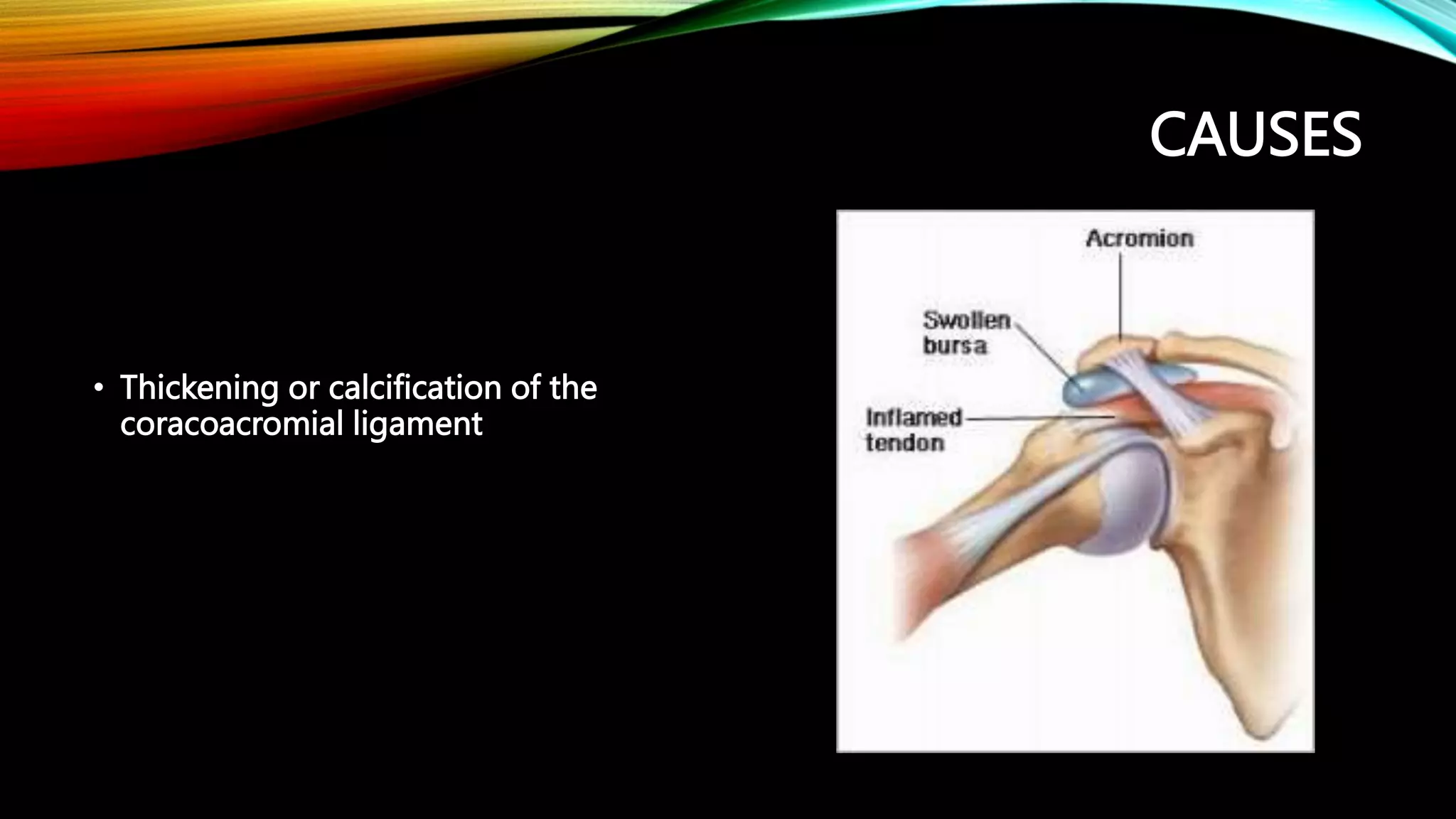 Painful Arc Syndrome.pptx