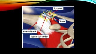 Painful Arc Syndrome.pptx