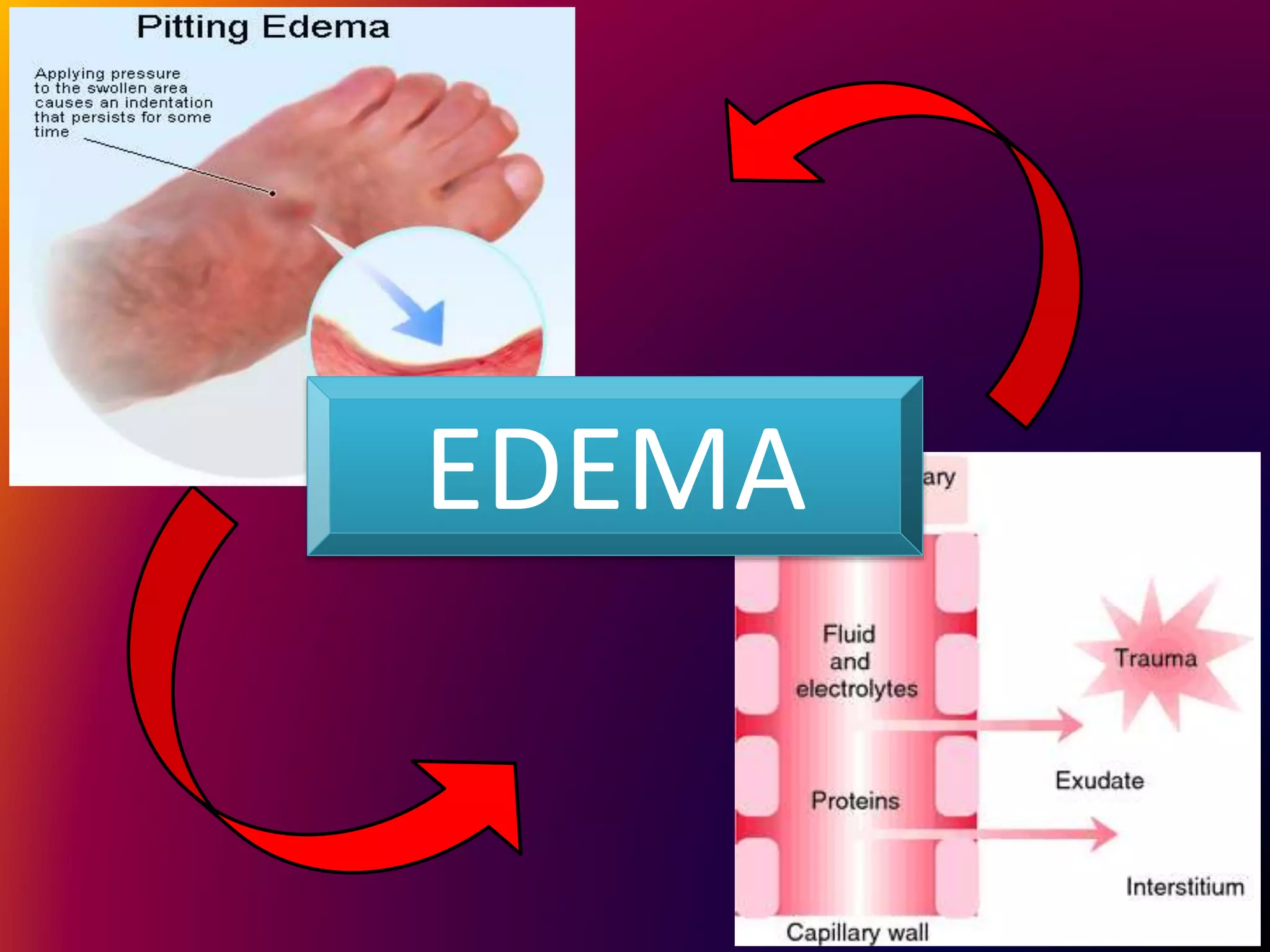Propedeutica fiebre, edema e inflamación | PPTX
