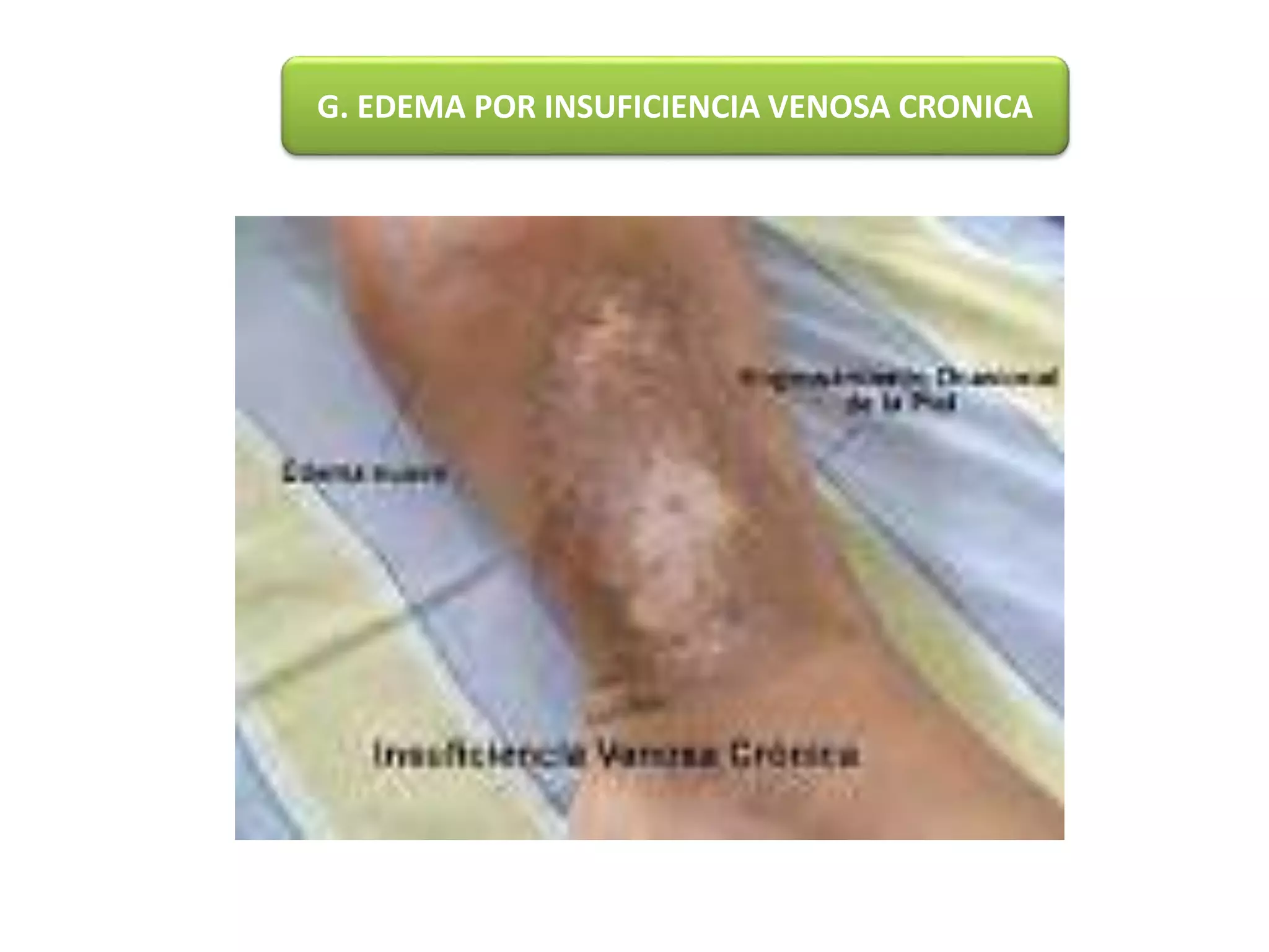 Propedeutica fiebre, edema e inflamación | PPTX