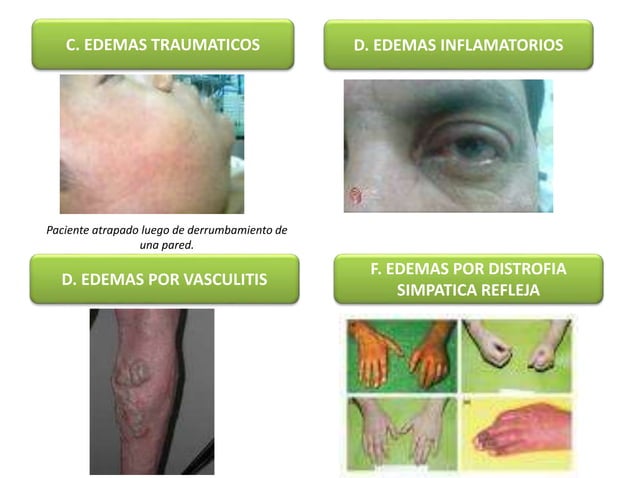 Propedeutica fiebre, edema e inflamación | PPTX