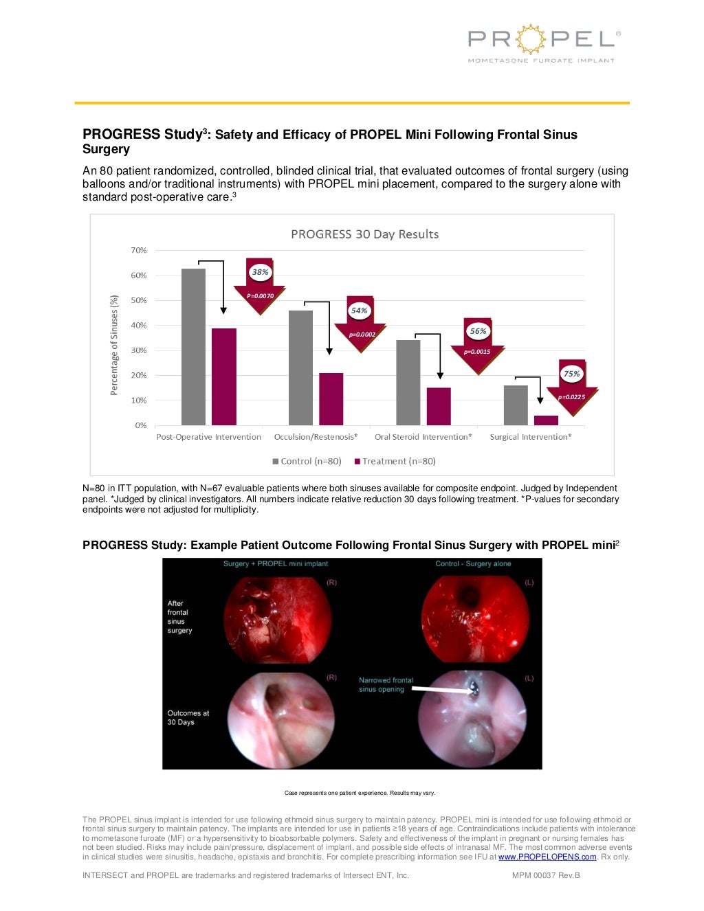 PROPEL Clinical Evidence Summary: Sinus Surgery Implants