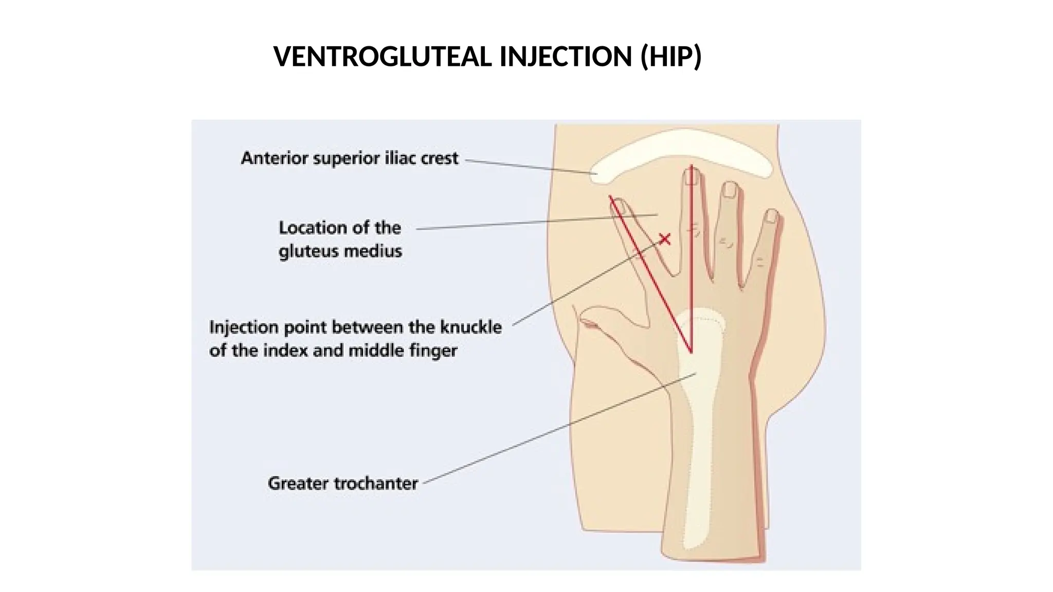 Proper Injection Techniques For nurses.pptx