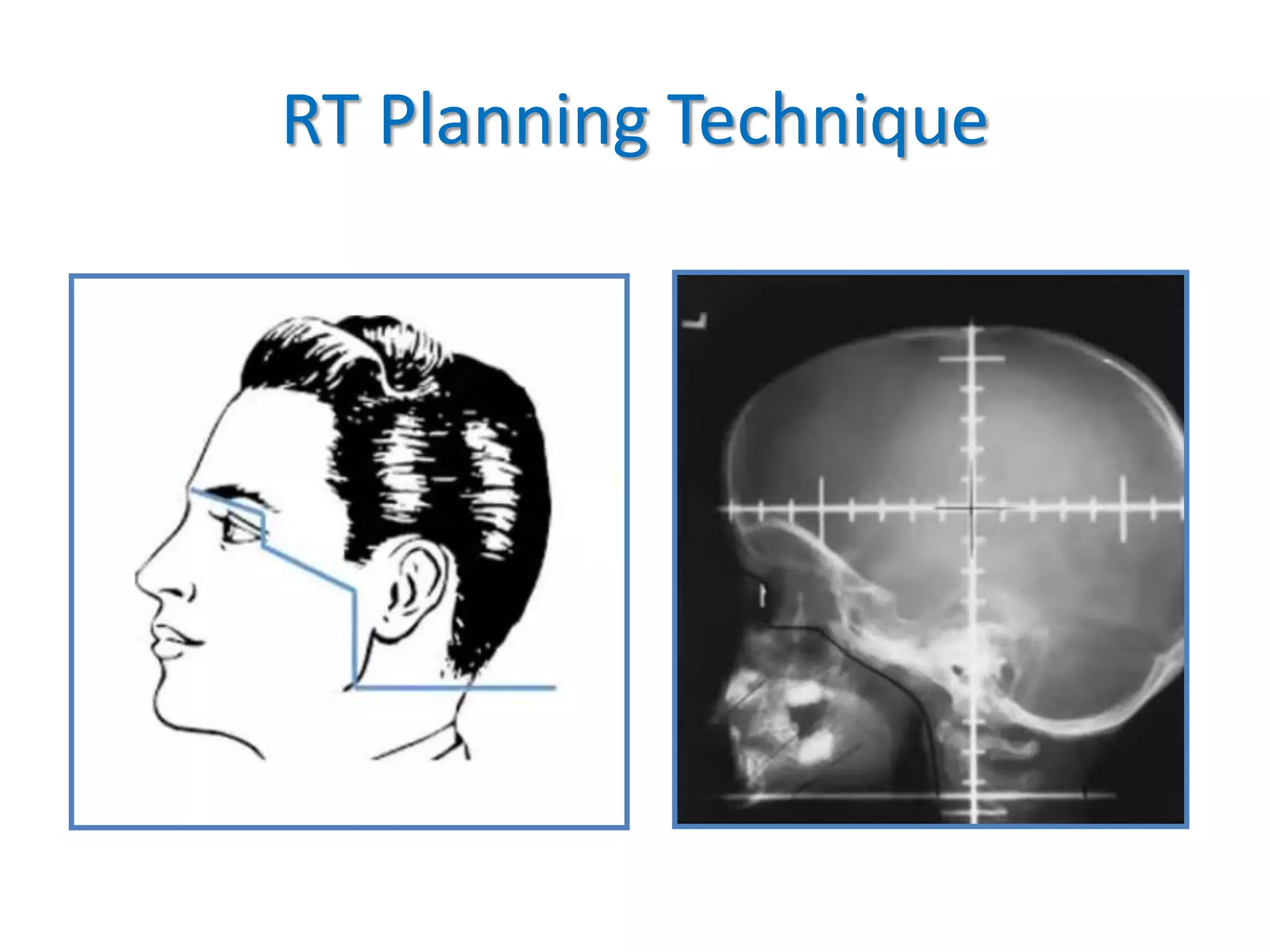 Prophylactic cranial irradiation | PPTX