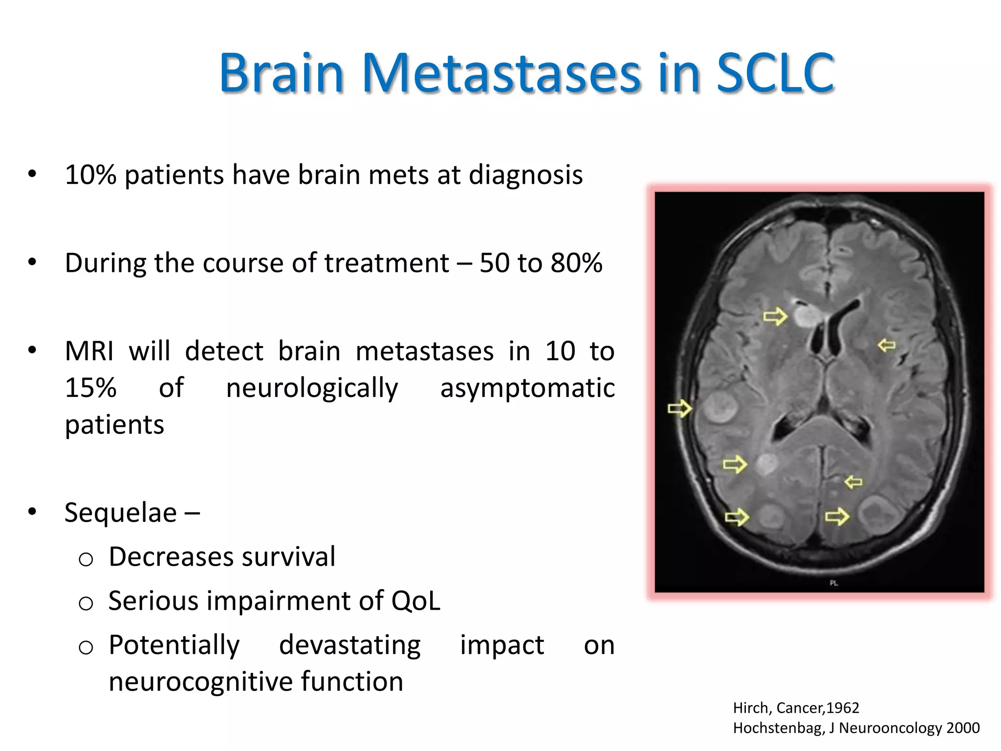 Prophylactic cranial irradiation | PPTX