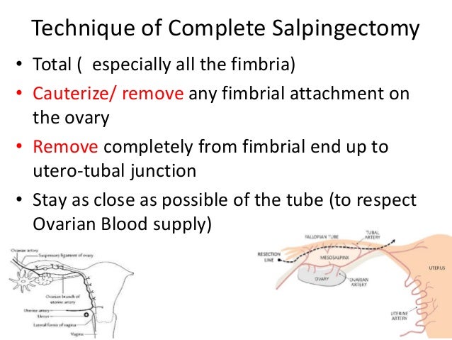 Prophylactic salpingectomy for reducing risk of ovarian cancer