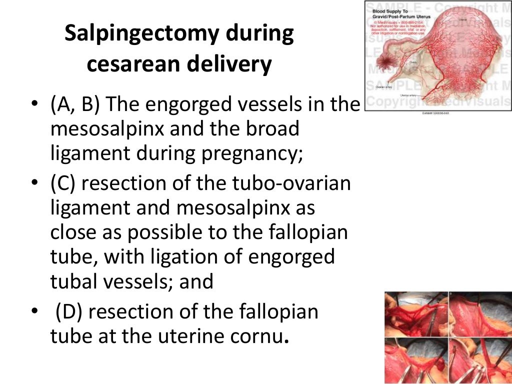 Salpingectomy In Ovaries | Salpingectomy: Procedure, Recovery, Risks ...