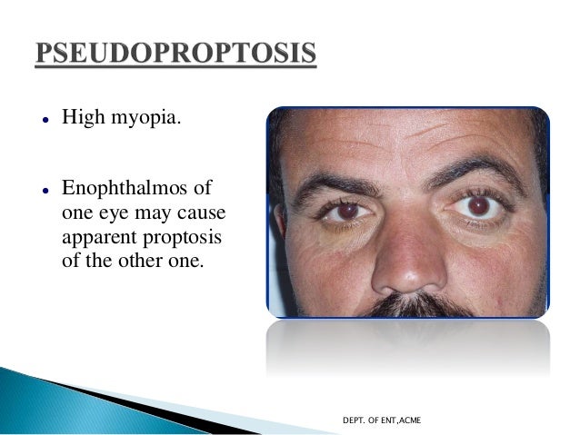 Proptosis by Dr.Ashwin Menon
