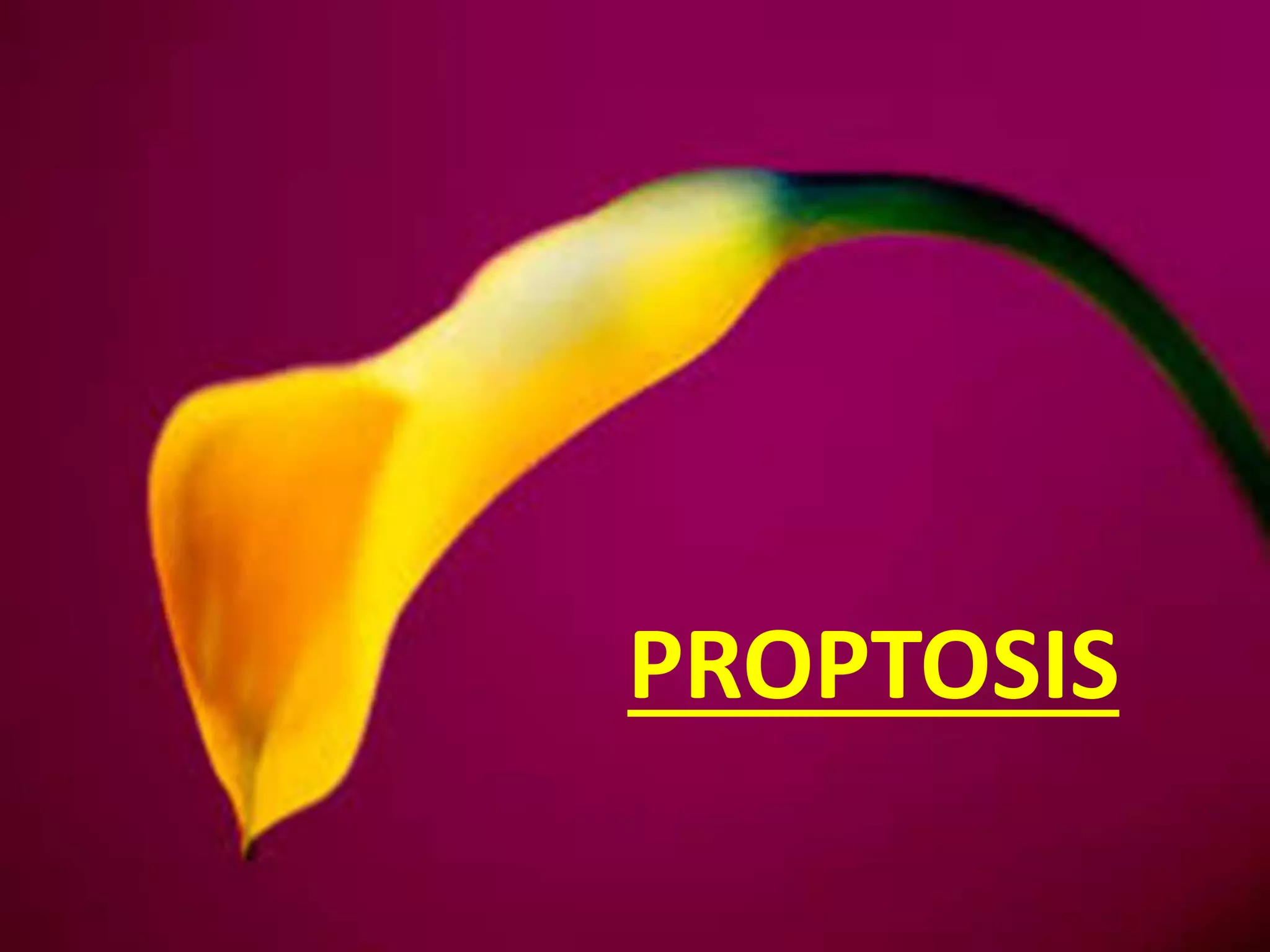 Proptosis in ophthalmology | PPTX