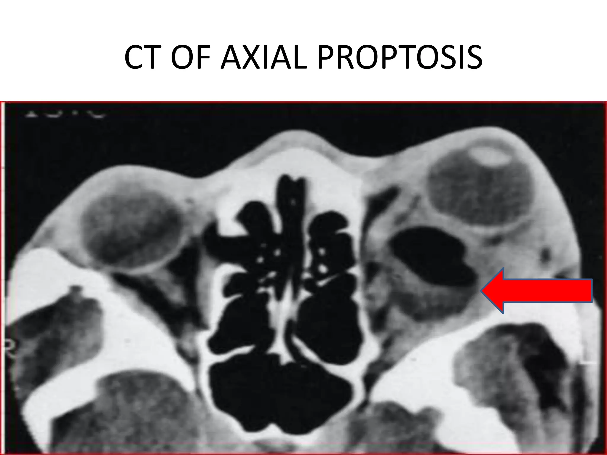Proptosis in ophthalmology | PPTX