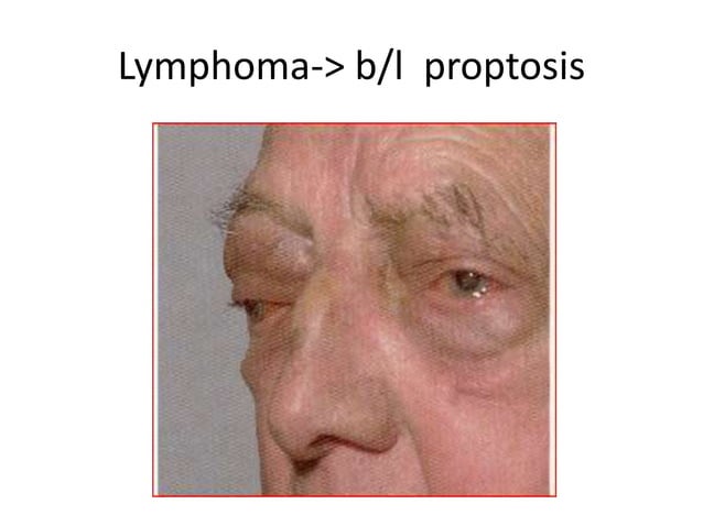 Proptosis in ophthalmology | PPTX