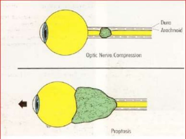 Proptosis in ophthalmology | PPTX