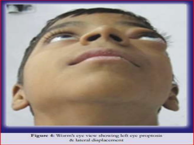 Proptosis in ophthalmology | PPTX