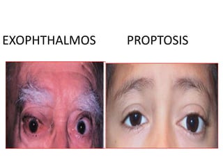 Exophthalmos Vs Proptosis