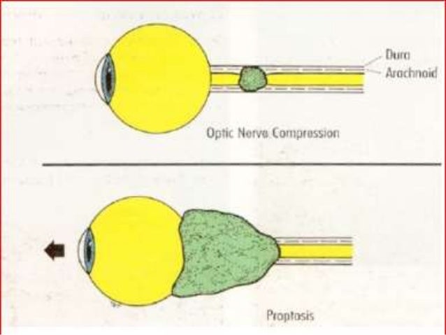 Proptosis in ophthalmology